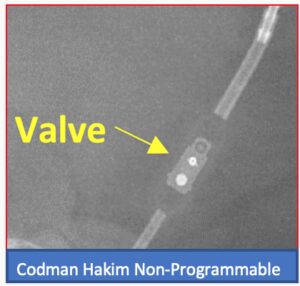 CSF Shunts – NHS GGC MRI Physics