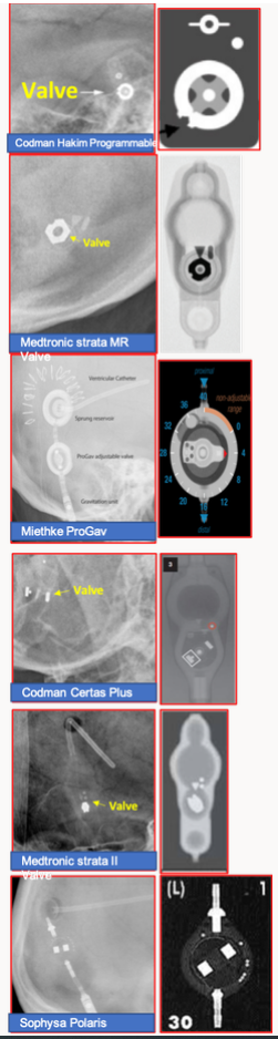 CSF Shunts – NHS GGC MRI Physics