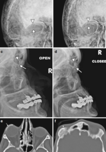 Eyelid weights – NHS GGC MRI Physics