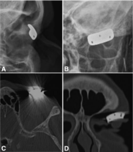 Eyelid weights – NHS GGC MRI Physics